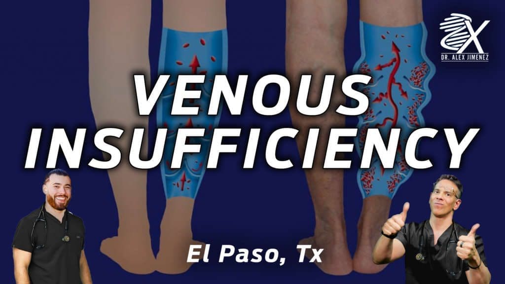 What You Need To Know About Venous Insufficiency - El Paso, TX Health ...